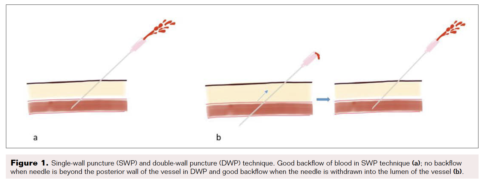 Traditional Seldinger Technique | Vascular Disease Management Traditional Seldinger Technique | Vascular Disease Management